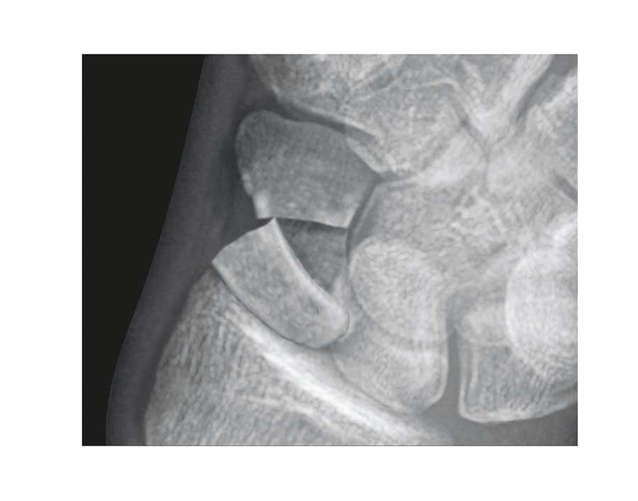 FRACTURE SCAPHOID Hand Surgery Resource